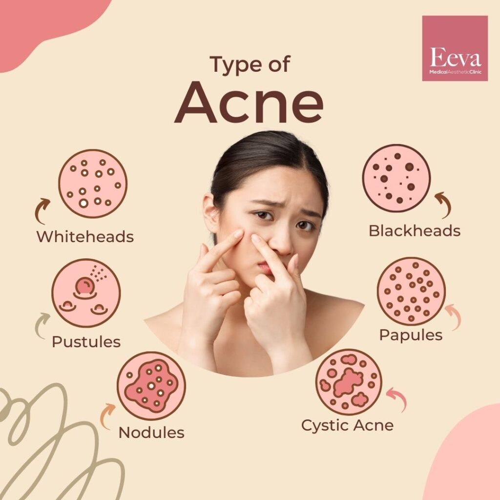 What is Acne? Explained - Prevention, Causes and Treatments | Eeva ...